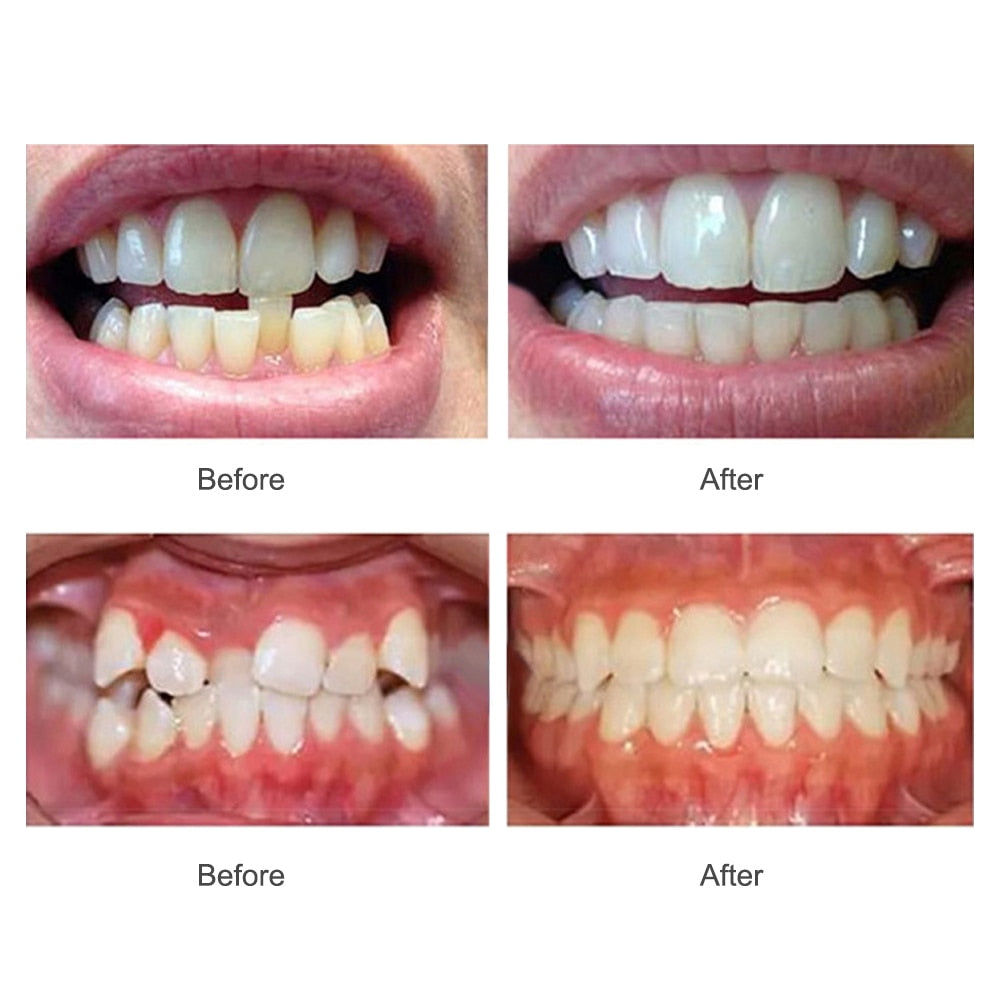 Orthodontic Teeth Alignment Trainer – Clickermans